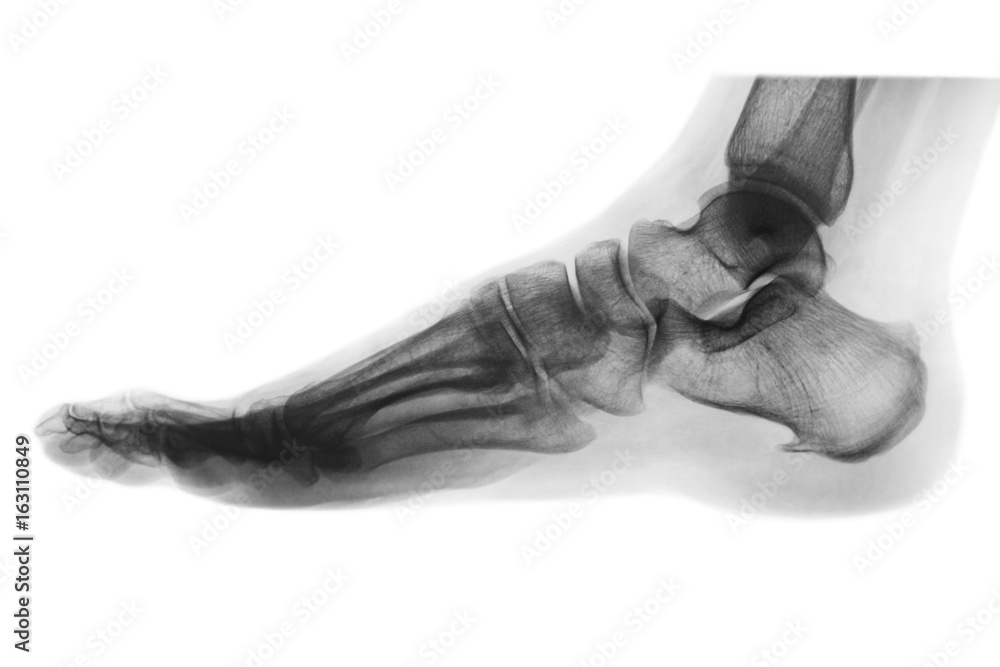 X-ray normal human foot . Lateral view . Invert color style . Stock ...