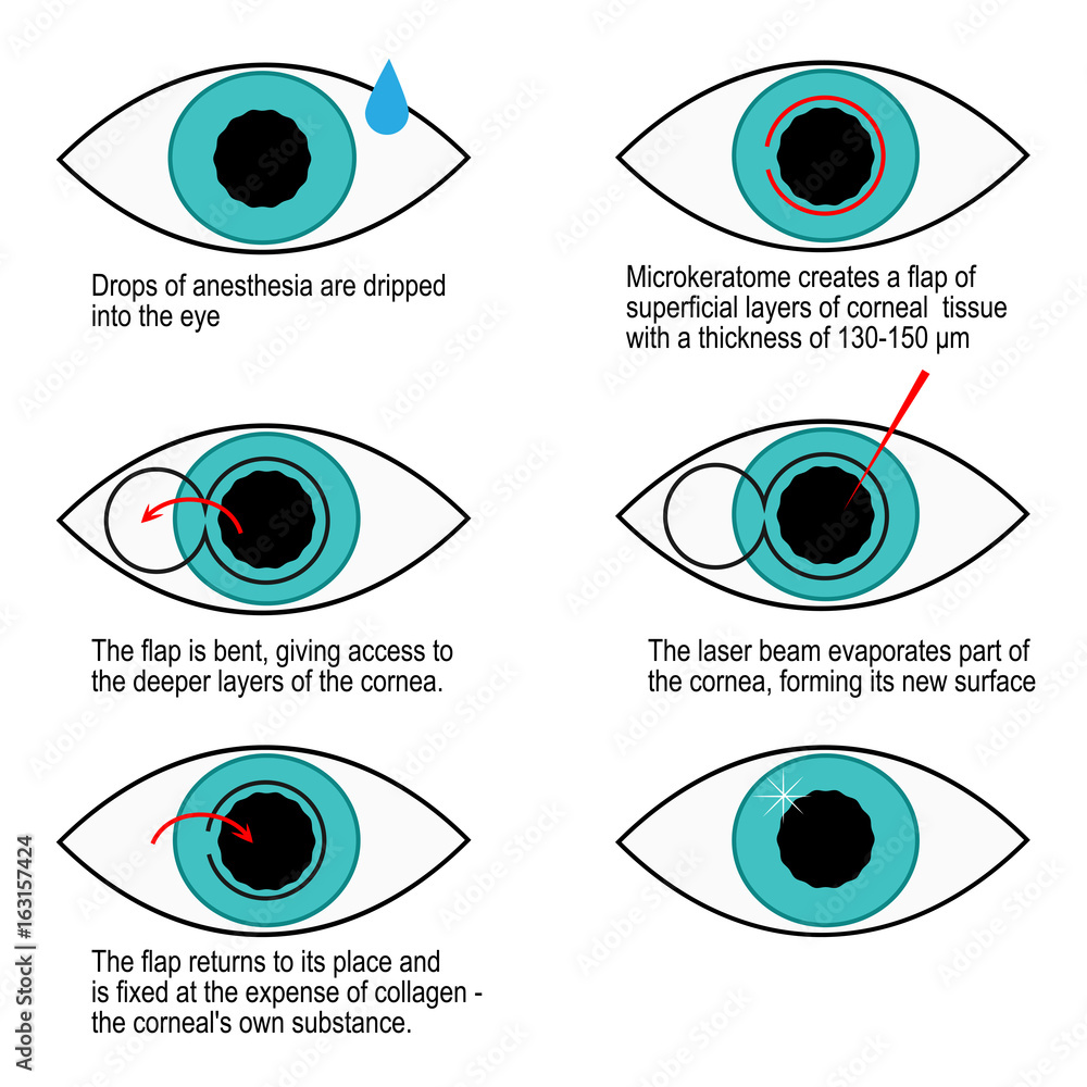 Procedure of laser correction of vision step by step. Infographics ...