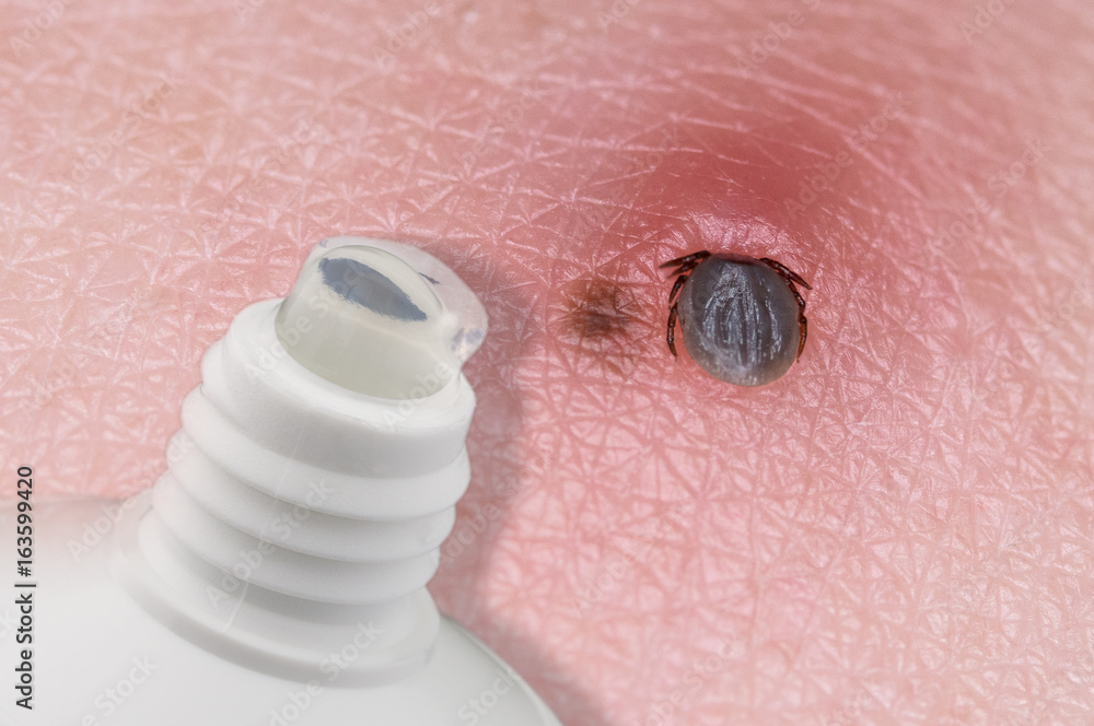 Parasites In Human Skin