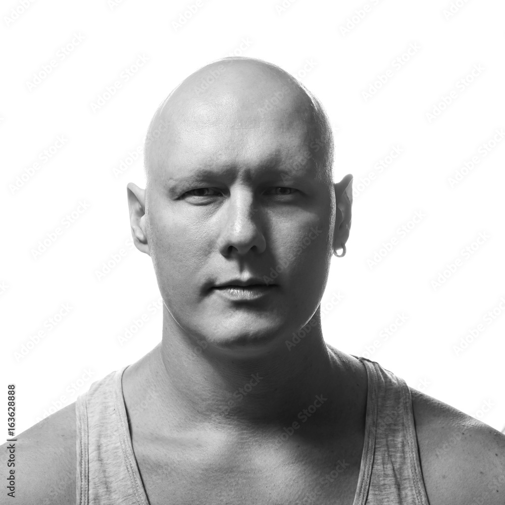 Autoimmune total alopecia men portrait. Absolute bald head without ...