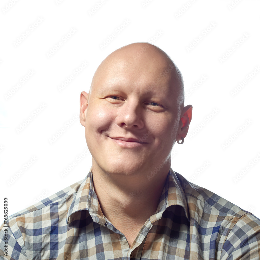 Autoimmune total alopecia men portrait. Absolute bald head without ...