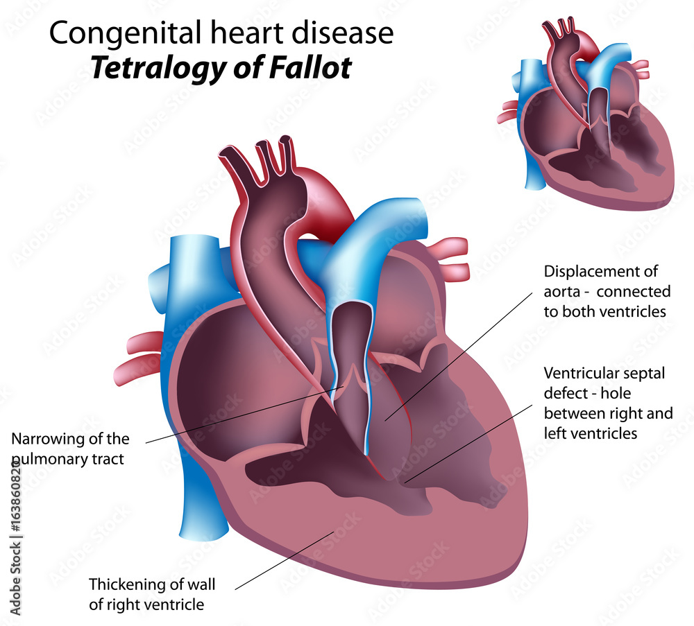 Congenital heart disease: Tetralogy of Fallot ilustração do Stock ...