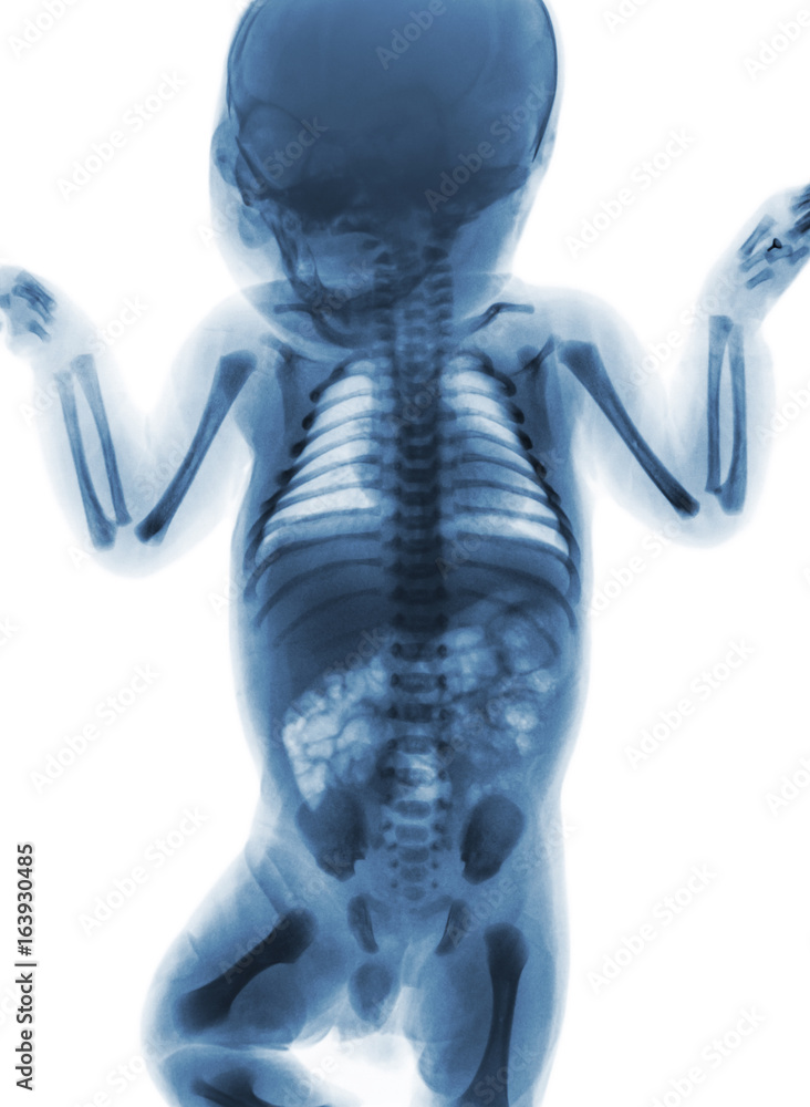 Film x-ray whole body of normal infant . front view . Stock Photo ...
