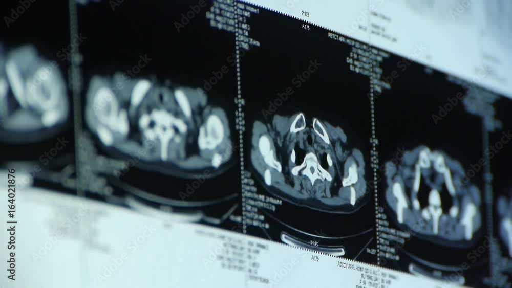 human subclavian pet-ct scan,lymph nodes X-ray,Cancer metastasis. Stock ...