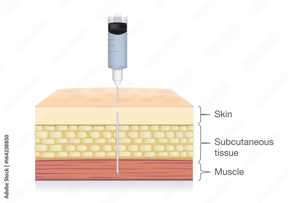 Injection needle insert medications into the muscle layer of skin ...
