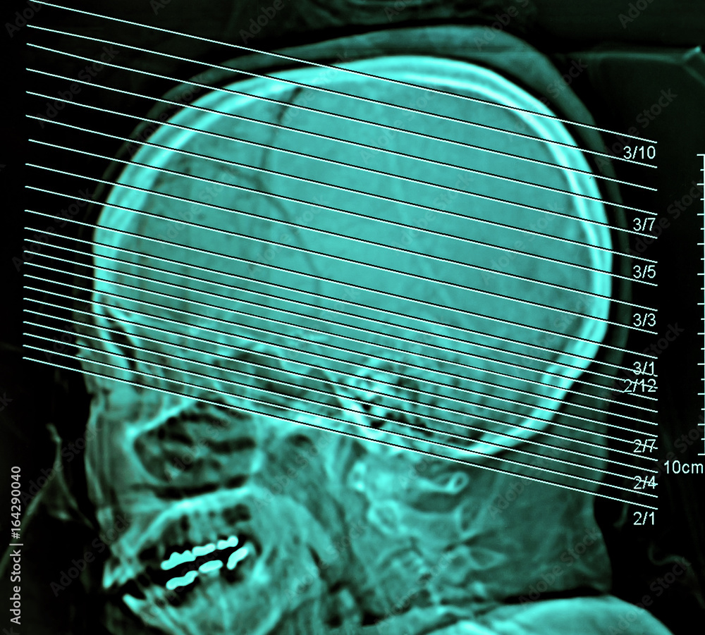Computerized film x-ray tomography of human brain, CT Scan, Medical ...