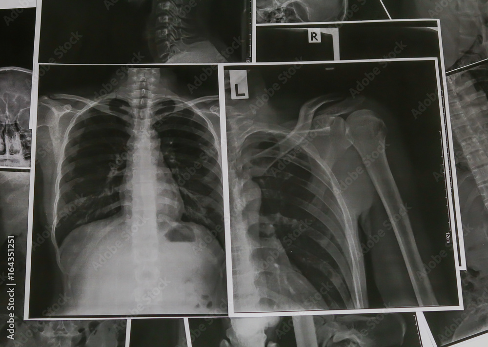 X-Ray Image of Human Chest for a medical diagnosis.Chest and lungs Xray ...