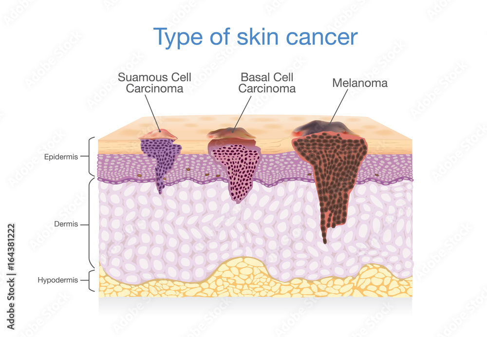 Skin layer have 3 Type of Cancer in one. Illustration about Medical ...