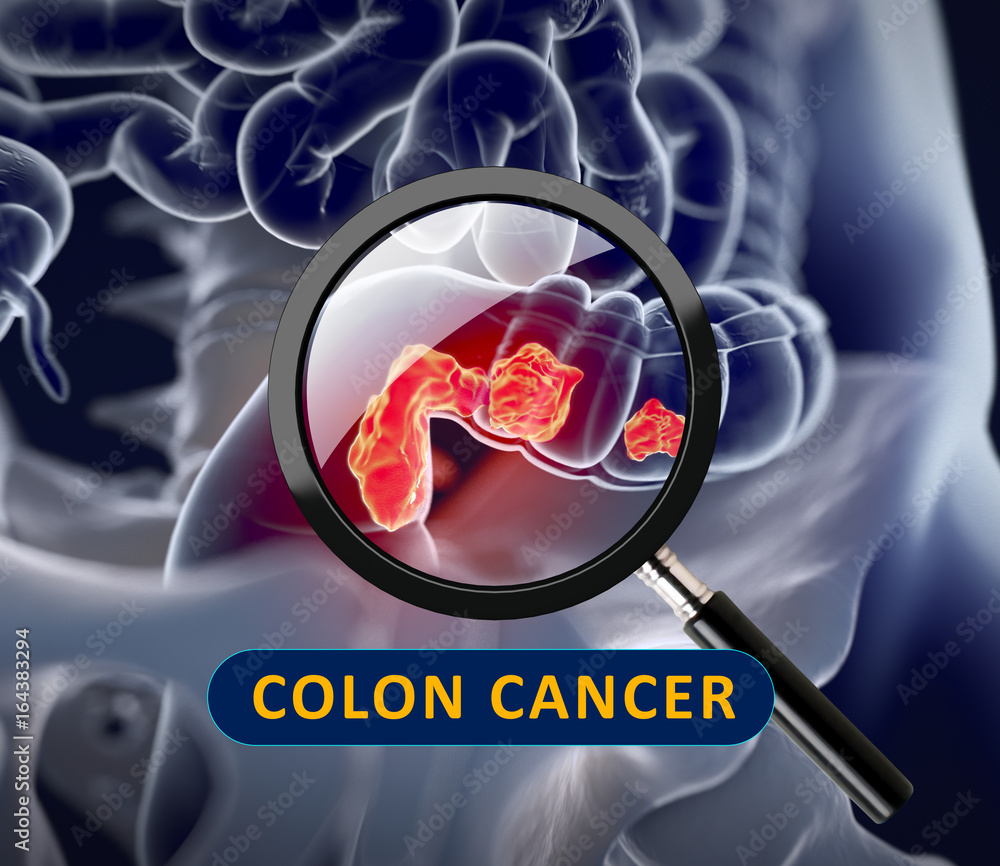 Colon or Colorectal cancer,medical anatomical illustration.3d ...