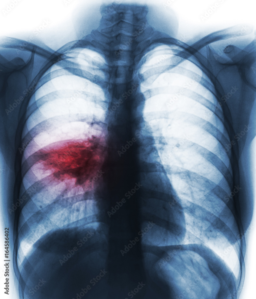 Pneumonia ( film chest x-ray show alveolar infiltrate at right middle ...