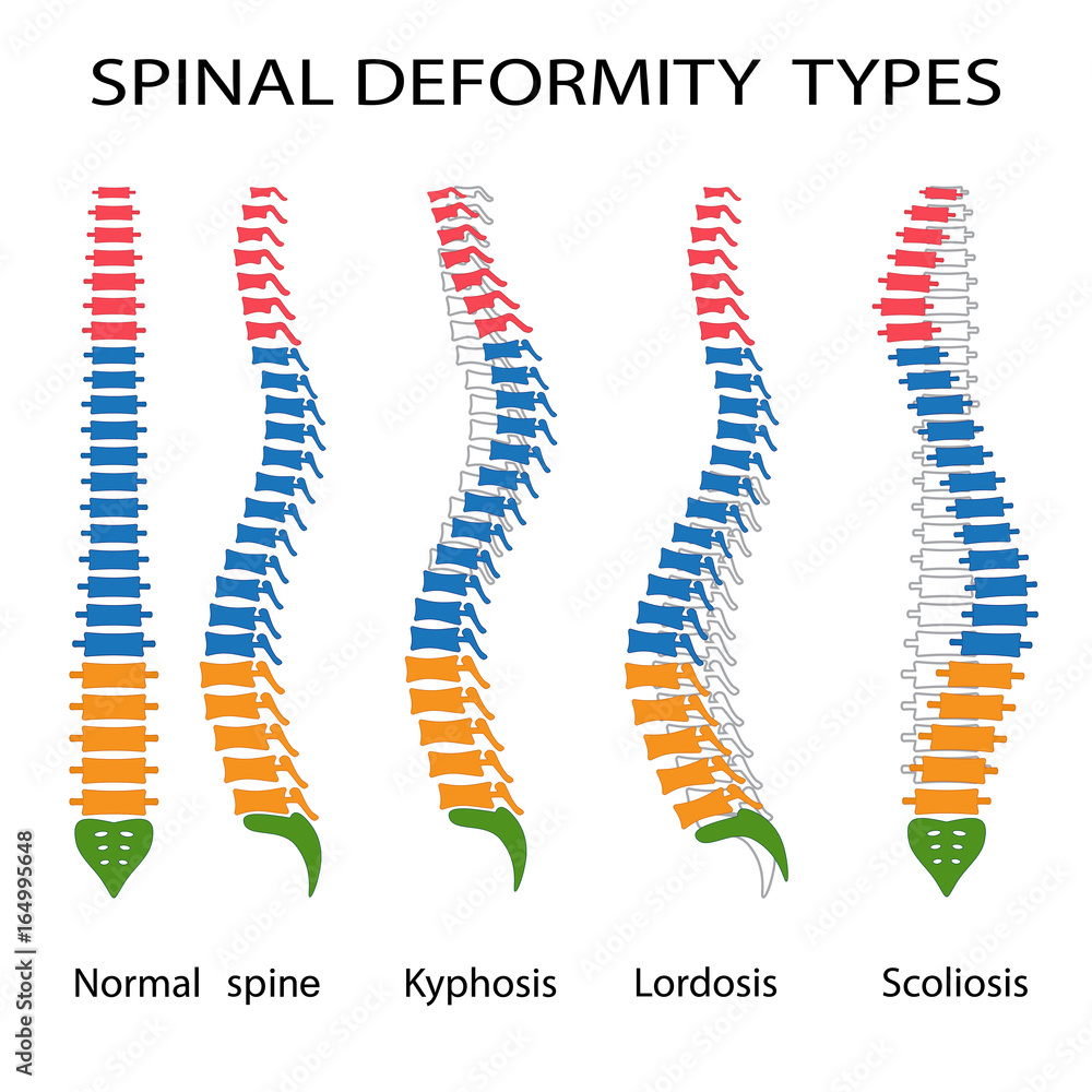 Spinal deformity types. Stock Vector | Adobe Stock