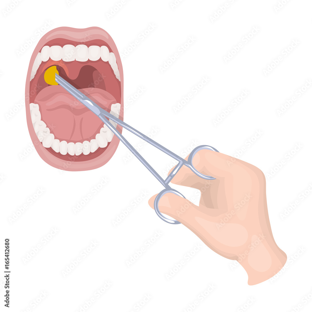 Treatment of the tonsils In the oral cavity. Medicine single icon in ...