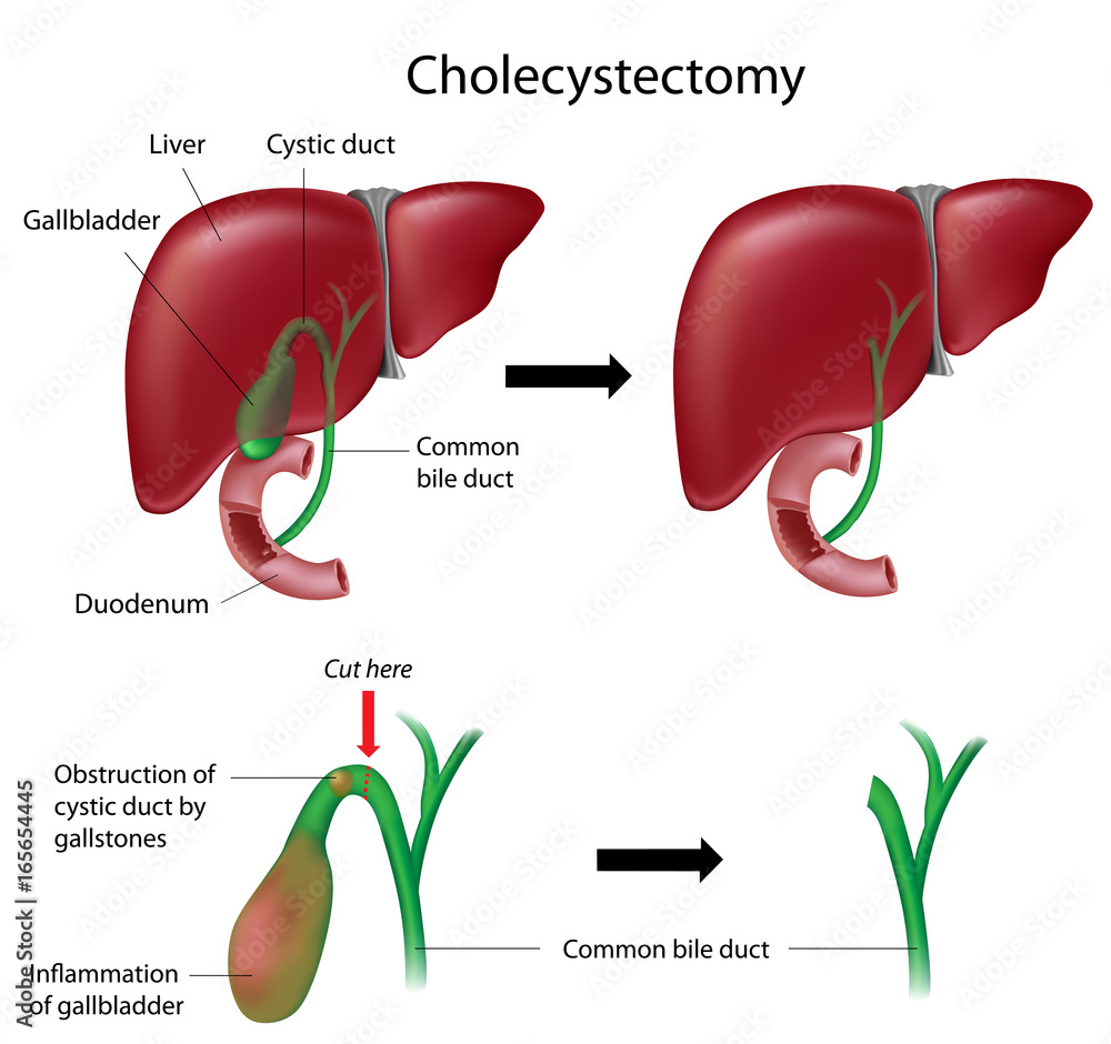Cholecystectomy - gallbladder removal surgery Stock Illustration ...