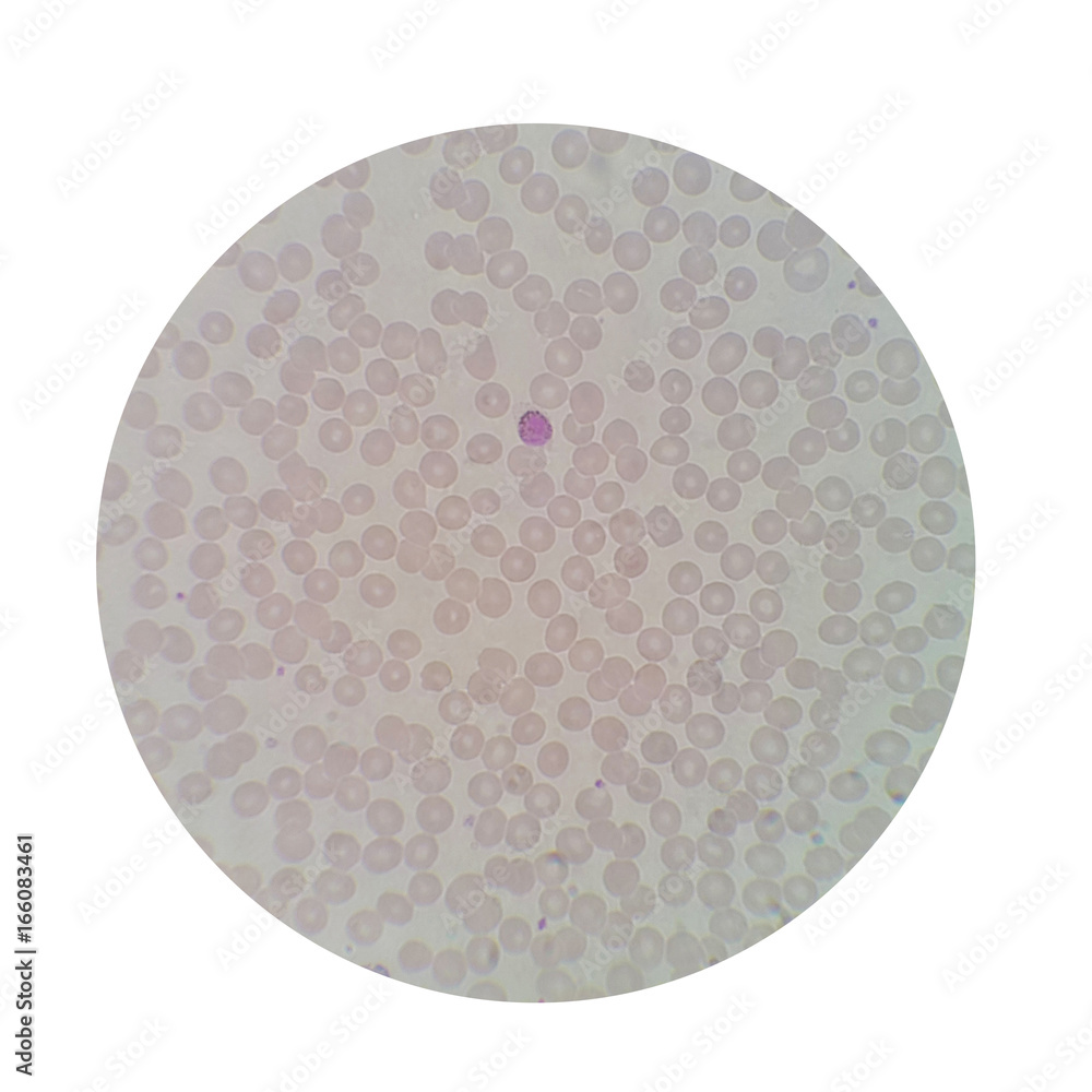 Microscopic examination of thin blood films smear from malaria infected ...