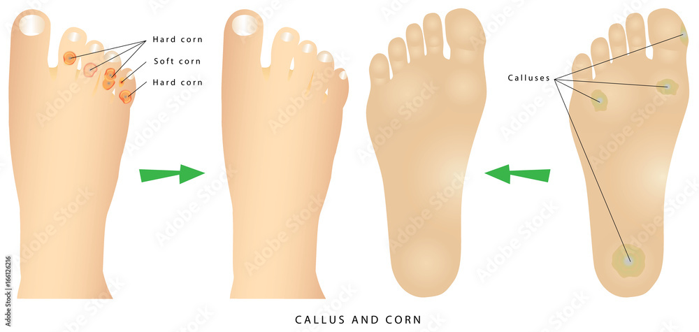 Corns and calluses Stock Vector | Adobe Stock