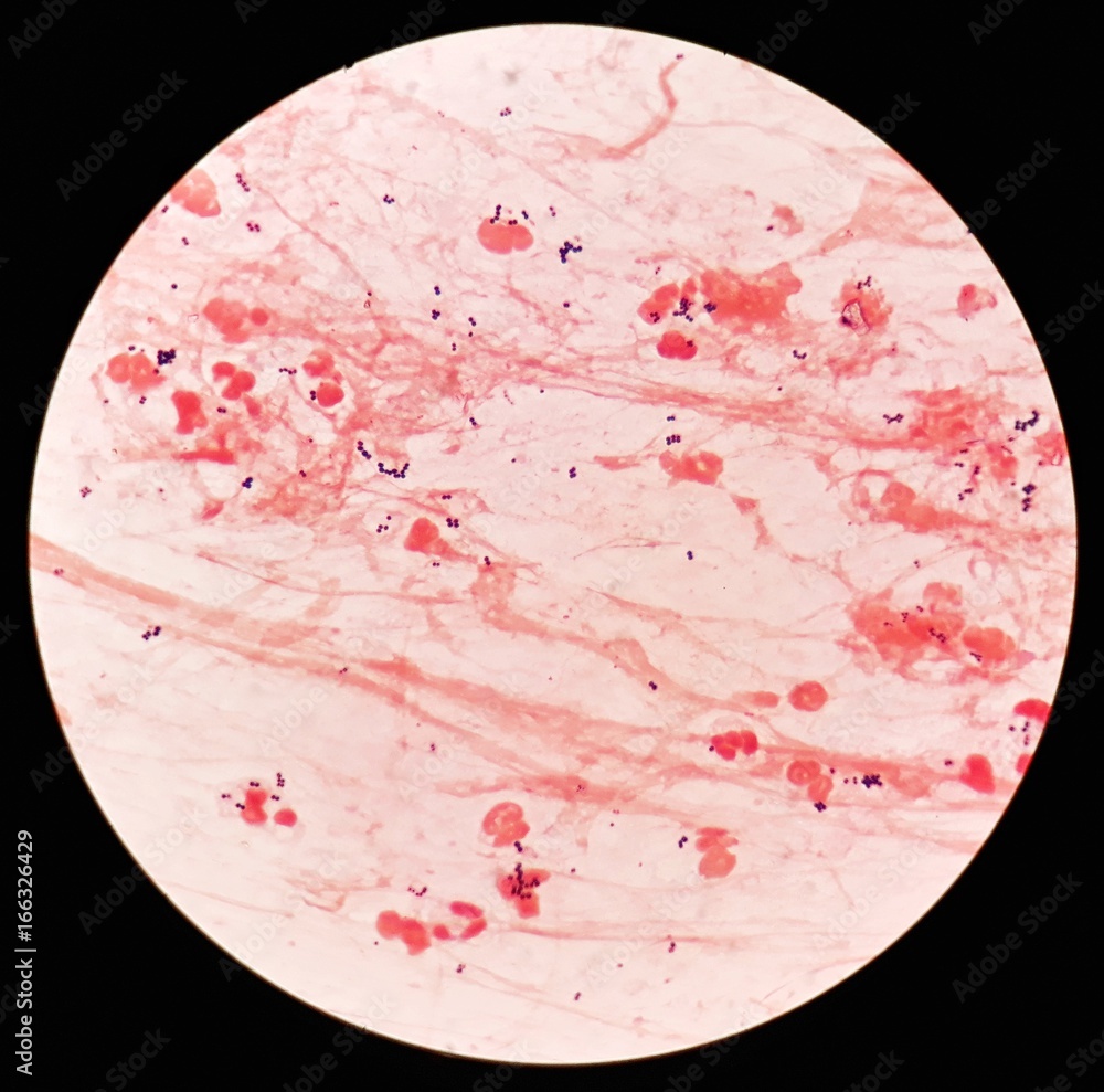 Smear of sputum specimen Gram's stained under 100X light microscope ...