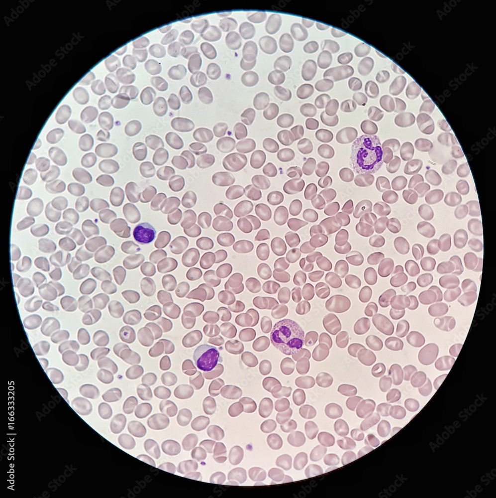 Human blood smear with abnormal red blood cells morphology call ...