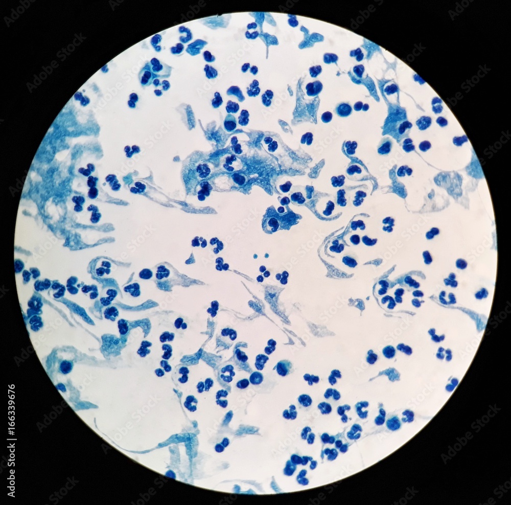 Smear of Acid-Fast bacilli (AFB) stained from sputum specimen with ...