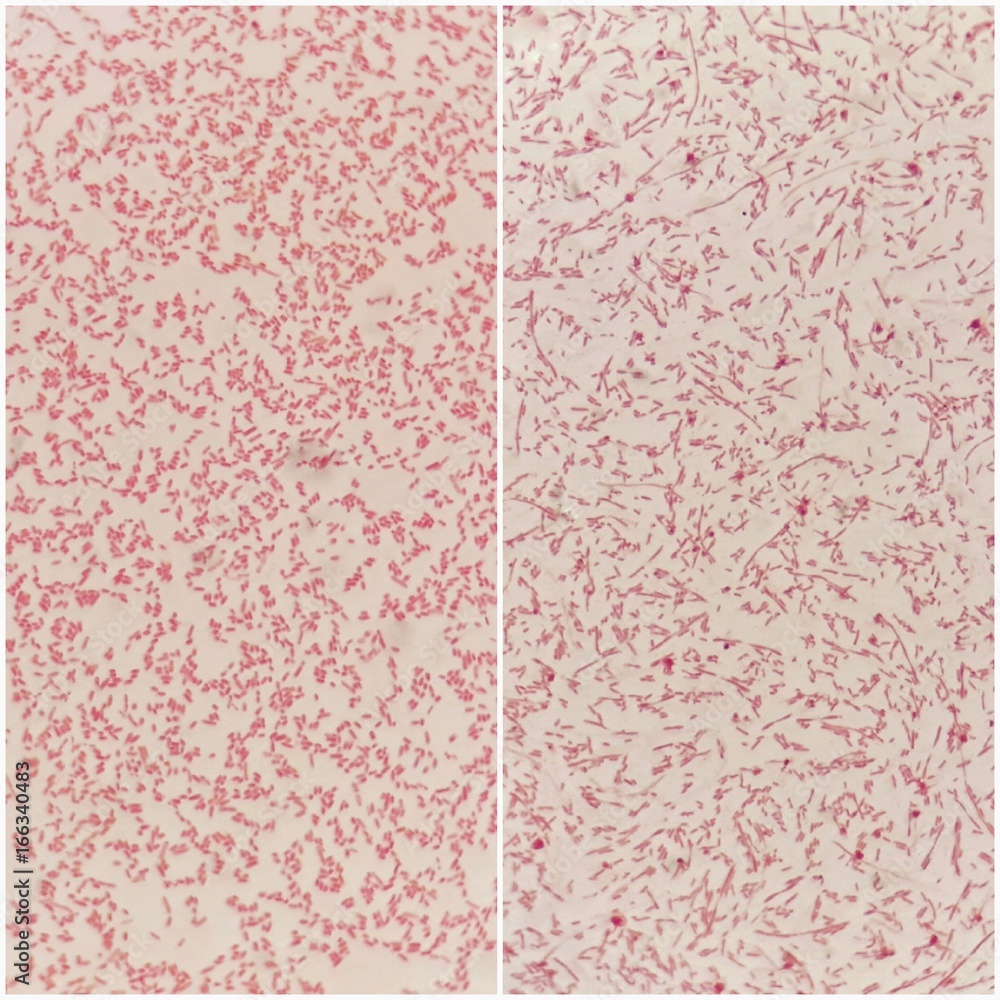 Two smear patterns of human blood cultured Gram's stained with gram ...