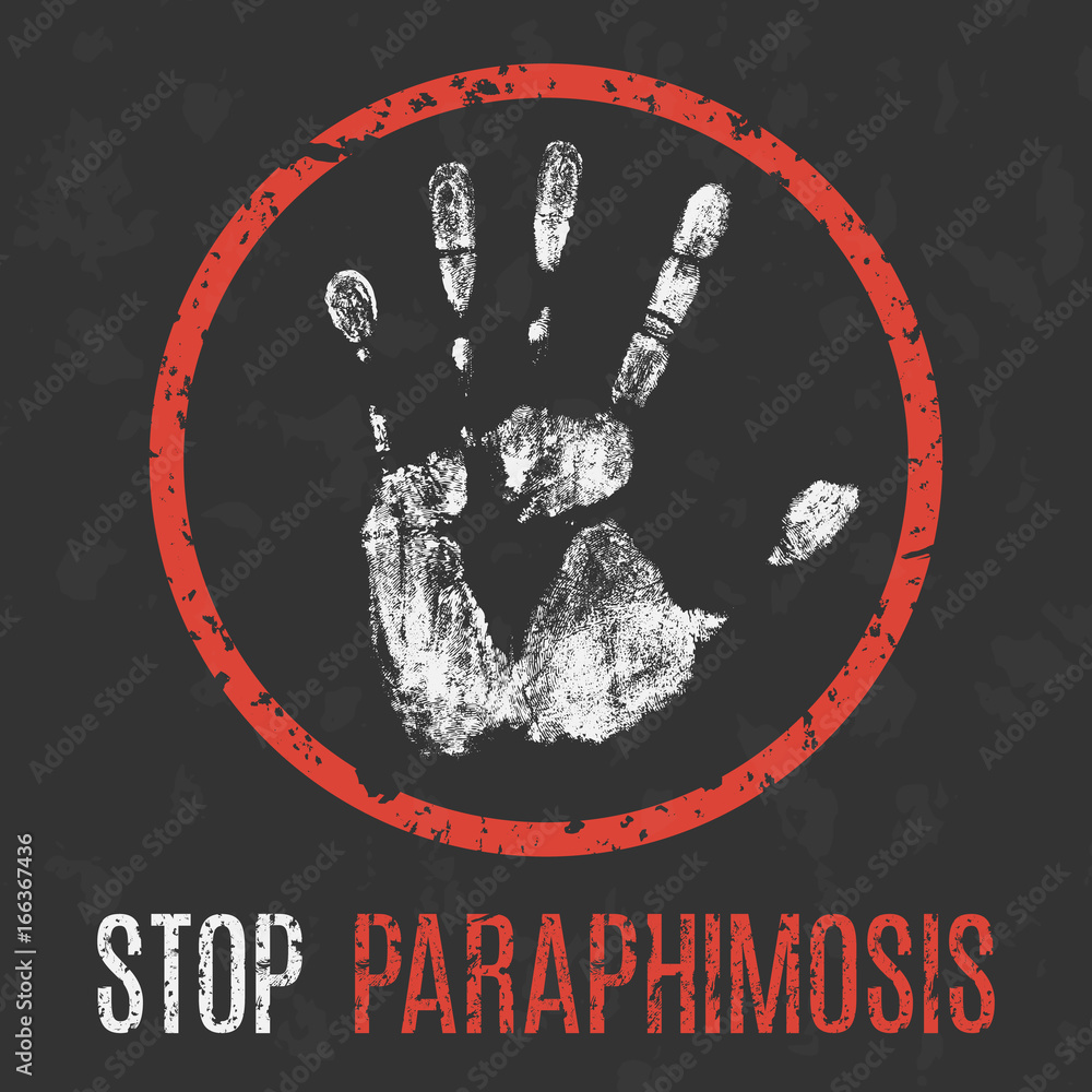 Vector illustration. The medical diagnosis. Stop paraphimosis. Stock ...