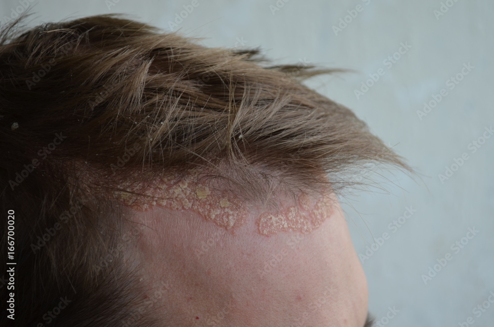 Psoriasis on the skin close-up, scalp, photos of dermatitis and eczema ...
