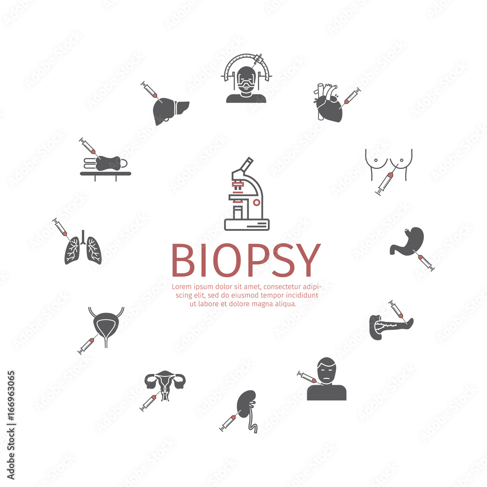Biopsy Types Of Biopsy Procedures Used To Diagnose Cancer Stock Vector biopsy-types-of-biopsy-procedures-used-to-diagnose-cancer-stock-vector