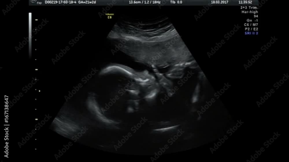 22 Weeks Ultrasound Ultrasound In Pregnancy Women's Ultrasound