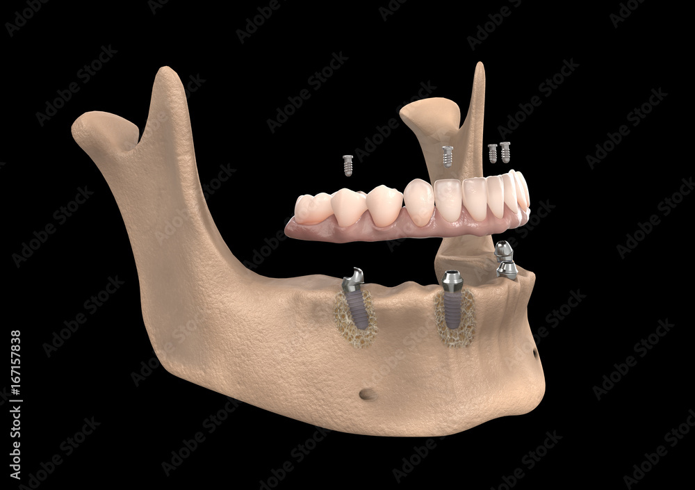 Dental anatomy - Lower teeth denture with bone structure and dental ...