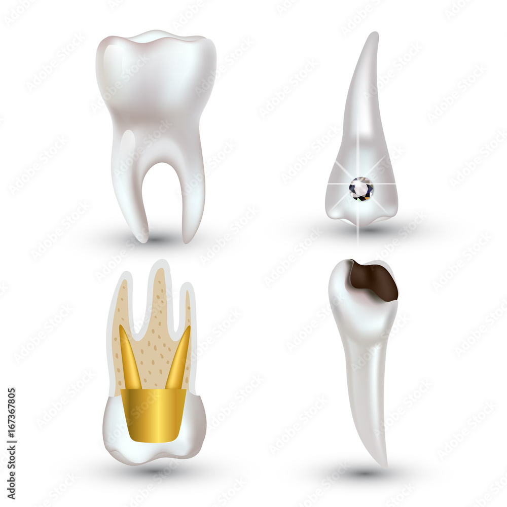 Vector set of 3d realistic clean and dirty tooth isolated on white ...