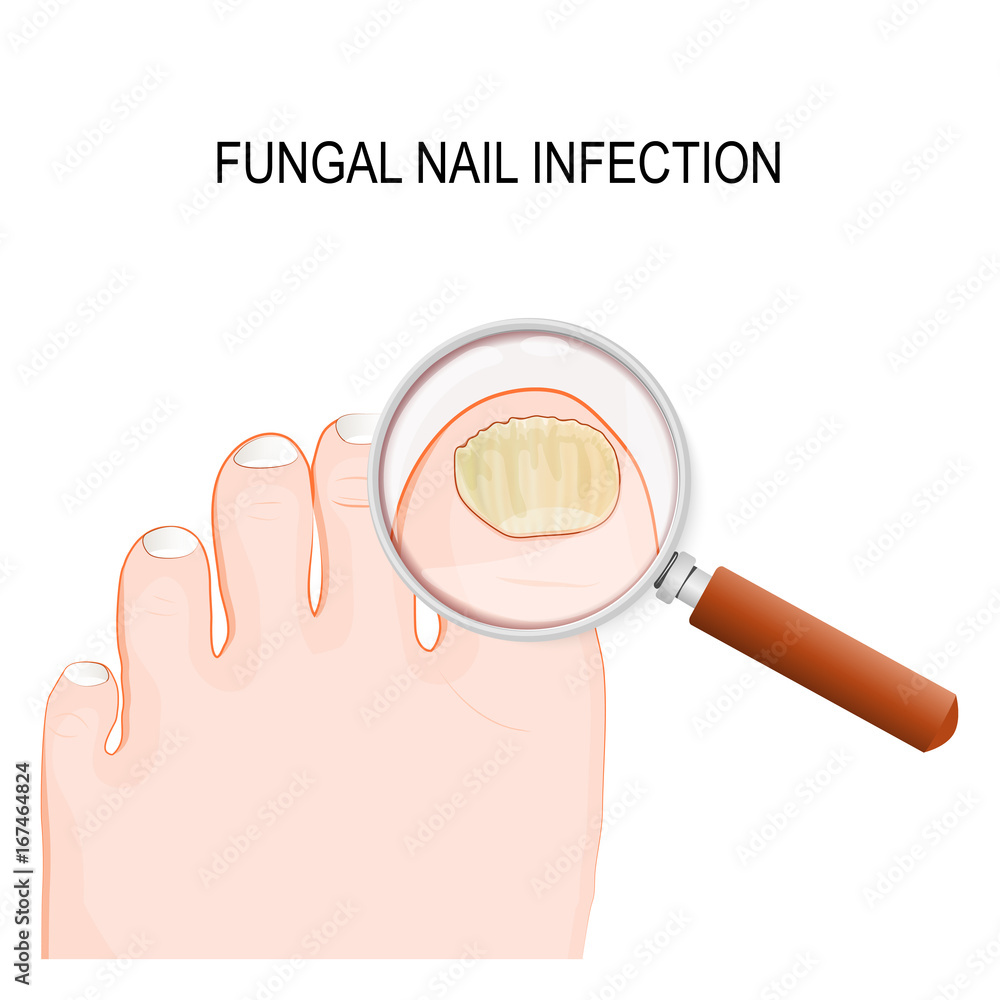 fungal nail infection Stock Vector | Adobe Stock