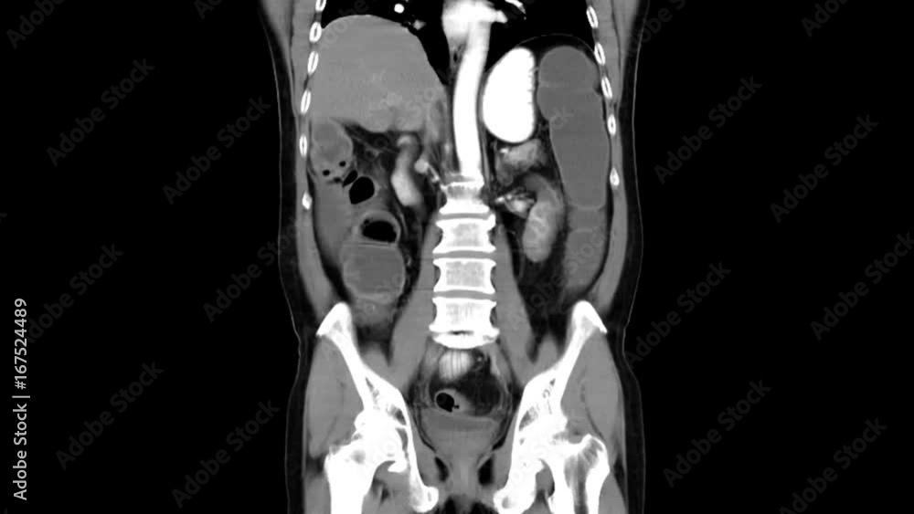 Abdominal CT Scan. Computed tomography of the abdomen of men with ...