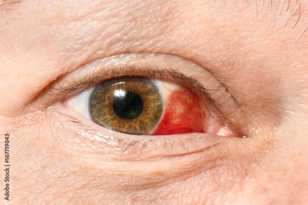Subconjunctival hemorrhage - hyposphagma. Closeup of woman's red ...