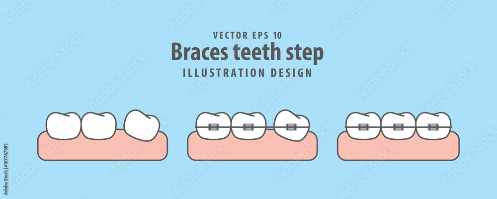 Braces teeth step illustration vector on blue background. Dental ...
