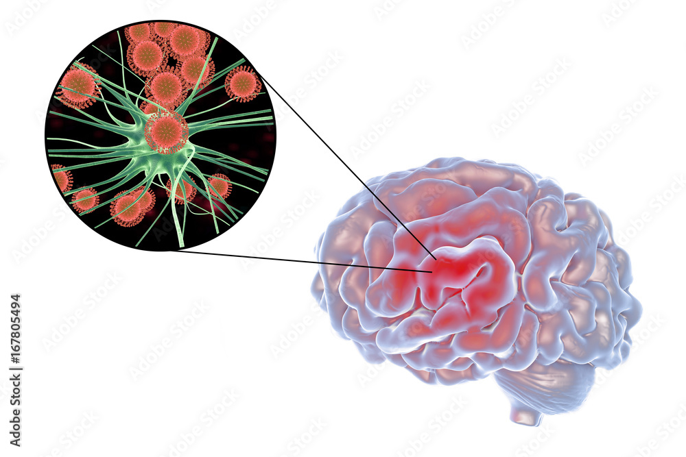 Viral encephalitis, 3D illustration showing brain and close-up view of ...