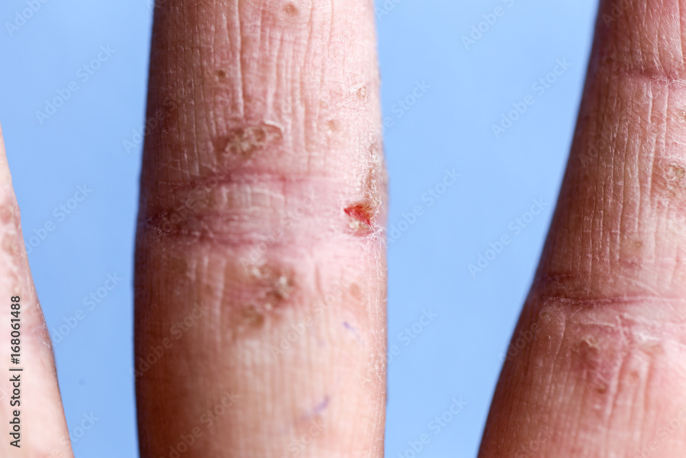 Atopic dermatitis (AD), also known as atopic eczema, is a type of ...