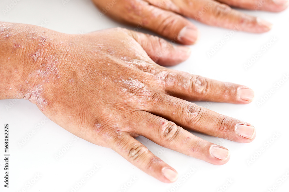 Atopic dermatitis (AD), also known as atopic eczema, is a type of ...