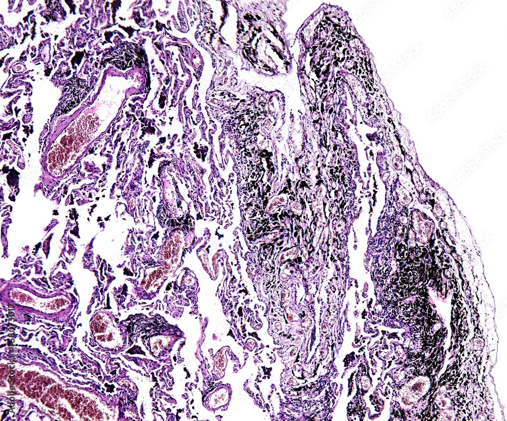 Histology of human tissue, show lung of smoking as seen under the ...