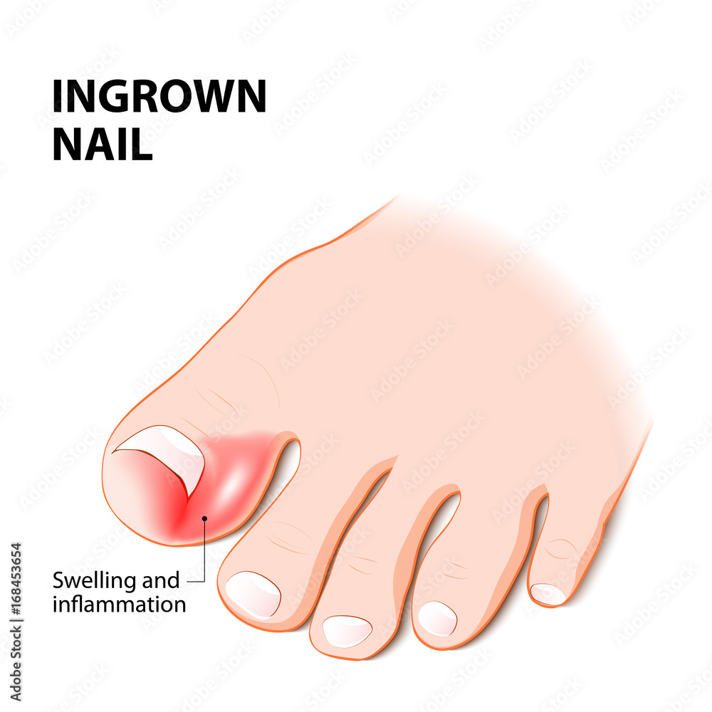 Ingrown nail. nail disease Stock Vector | Adobe Stock