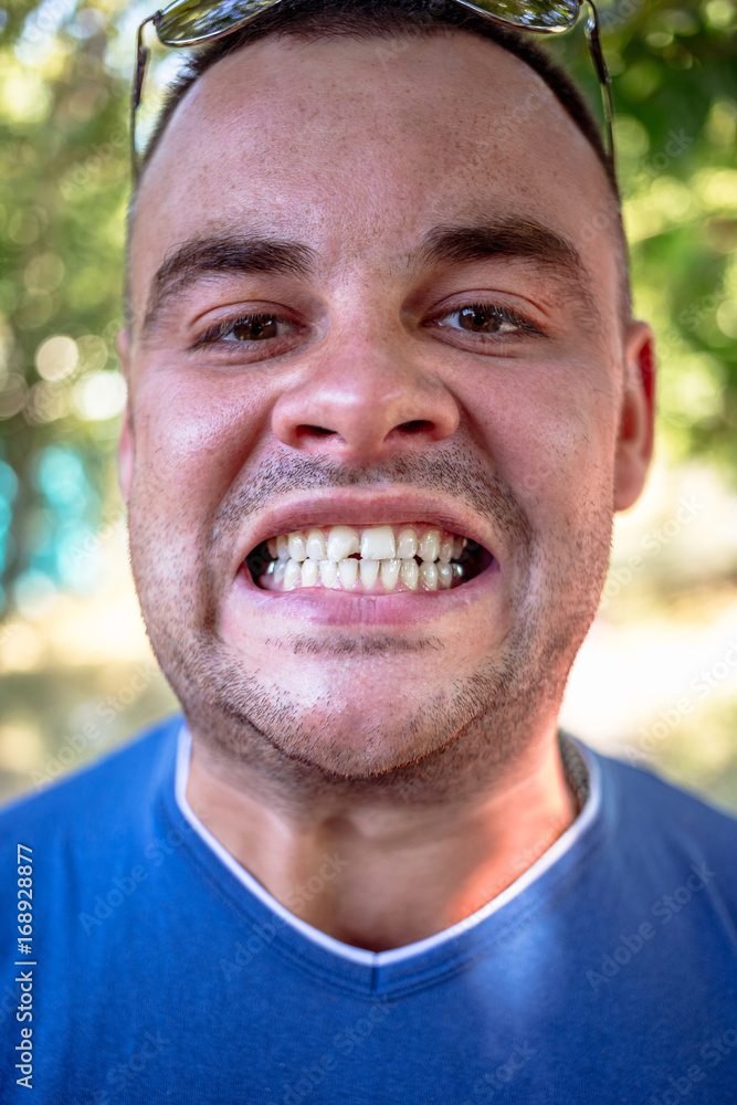 Young man in a blue T-shirt with a chipped tooth Stock Photo | Adobe Stock