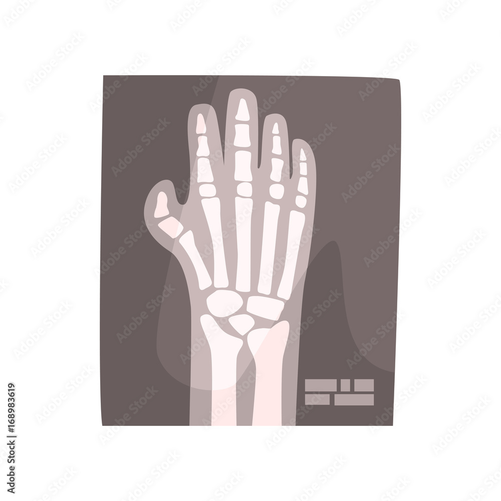 X ray image of human hand cartoon vector Illustration Stock Vector ...