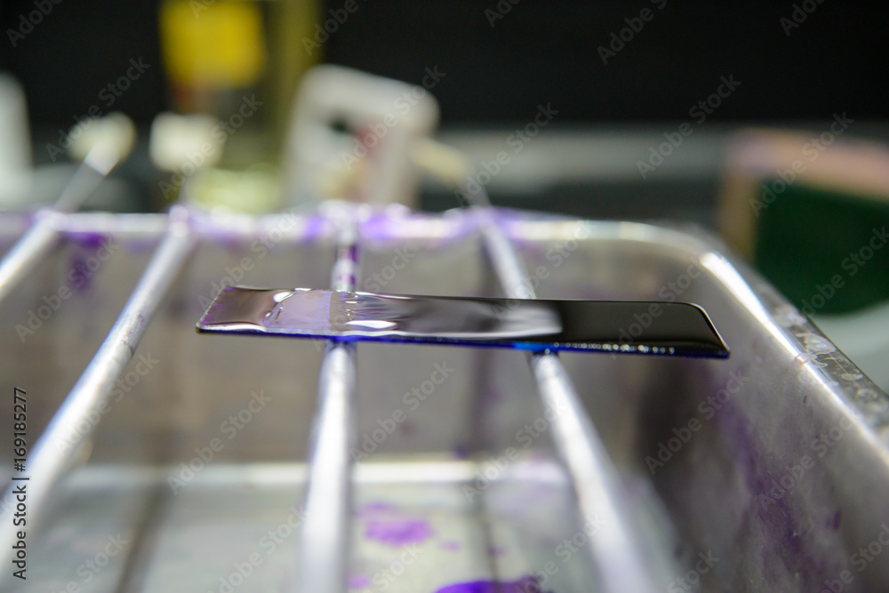 Close-up detail of a glass slide with sputum sample being stained with ...