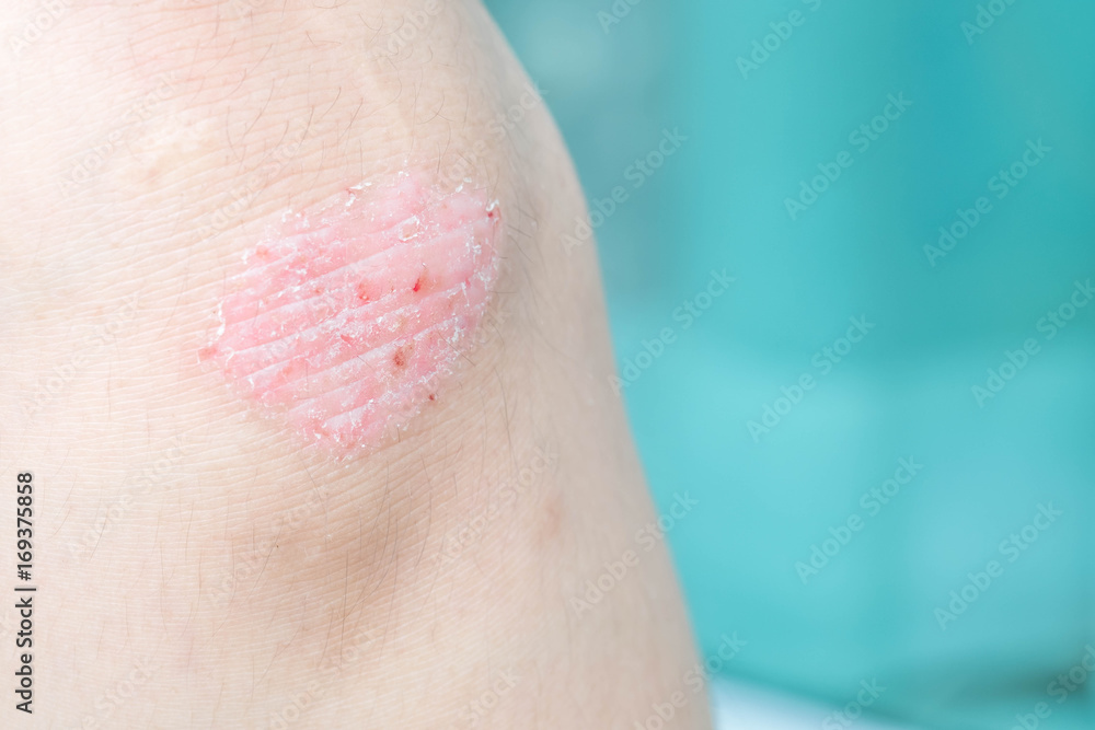 Psoriasis on the knee shows redness and applying and dry flaky skin and ...