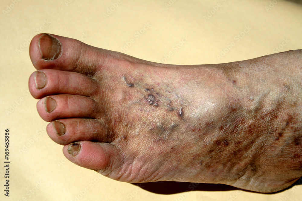 Varicose veins. Thrombosis. Foot. Extension of veins on the leg. Stock ...