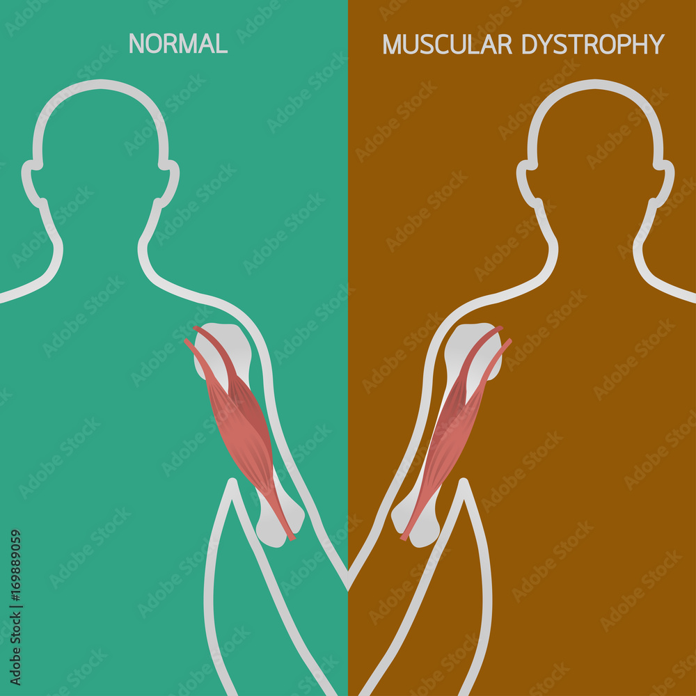 Muscular dystrophy vector illustration เวกเตอร์สต็อก | Adobe Stock