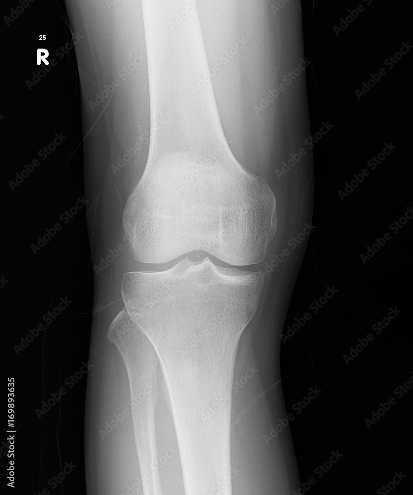 Film normal right knee AP view. Small joint effusion is seen, no ...