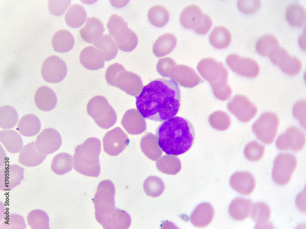 Blood picture of acute myeloid leukemia (AML) cells, analyze by ...