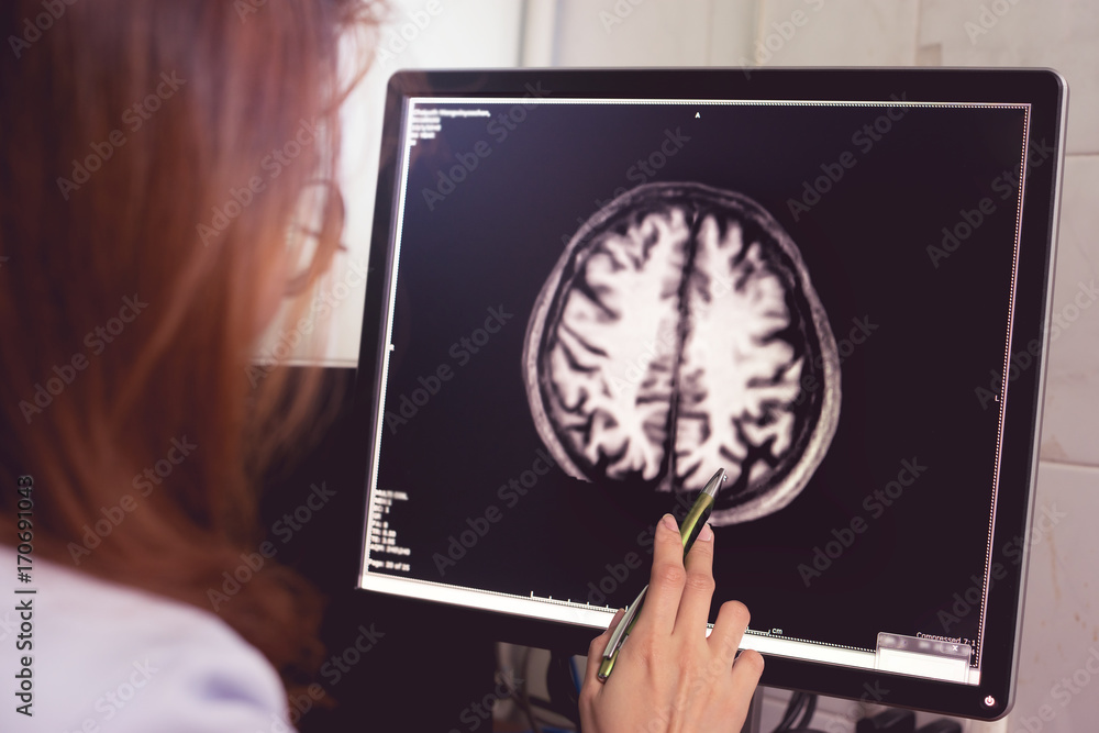 MRI brain of Dementia patient with left parietal atrophy asymmetry ...