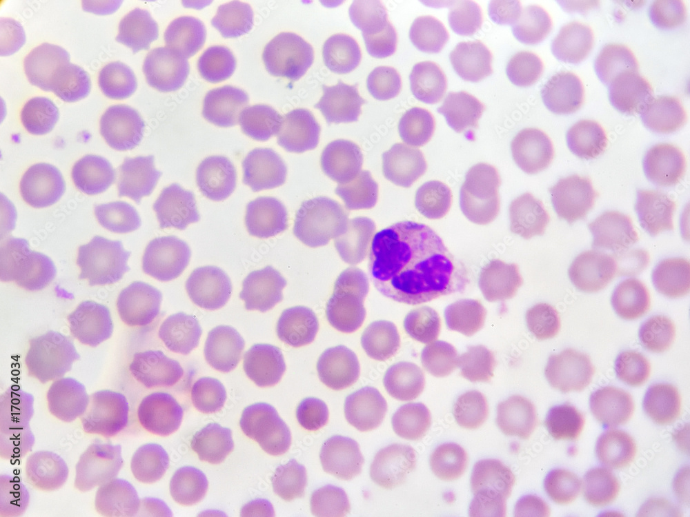 Neutrophil cell (white blood cell) in blood smear, analyze by ...