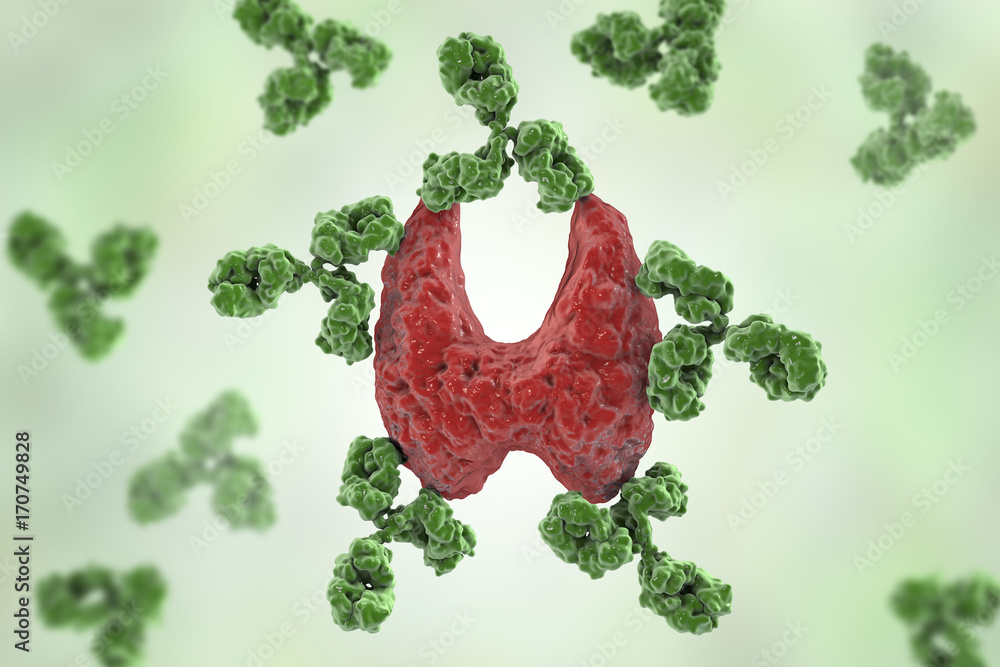 Autoimmune thyroiditis, Hashimoto's disease. 3D illustration showing ...