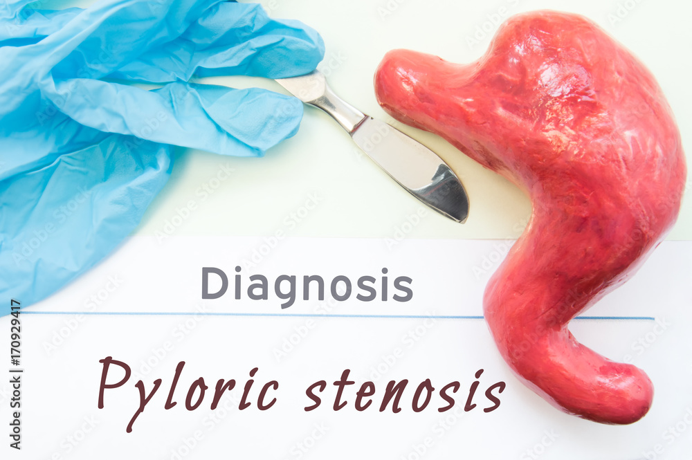 Diagnosis of Pyloric Stenosis. Figure stomach, scalpel and surgical ...